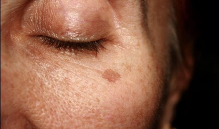 Cómo prevenir y tratar manchas oscuras en la piel